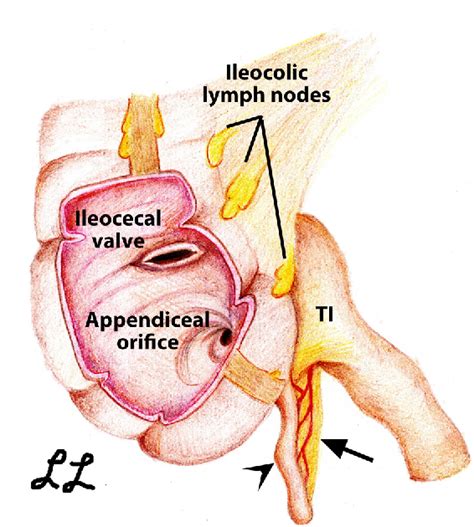 Figure 1 From Neoplasms Of The Appendix Pictorial Review With Clinical And Pathologic