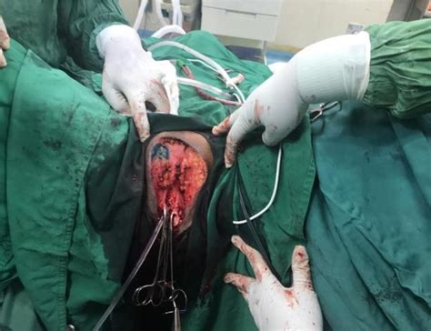 Figure 3 From Radical Vulvectomy For A Rare Case Of Squamous Cell