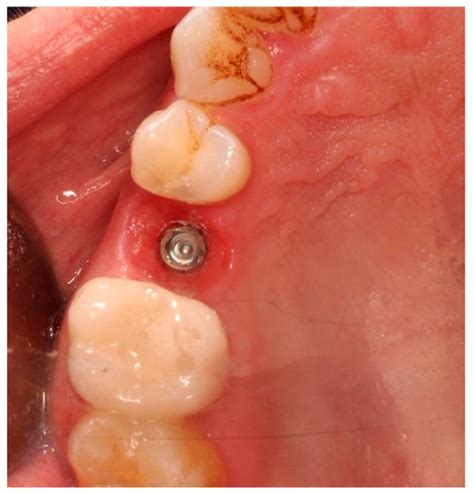 Prosthesis An Open Access Journal From Mdpi Prosthesis An Open Access Journal From Mdpi