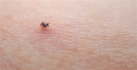 틱 매크로 사진 인간의 피부에 Ixodes Ricinus 분홍색 자극받은 표피 배경에 물린 부풀어 오른 기생충 거미류에 대한 스톡 사진 및 기타 이미지 Istock