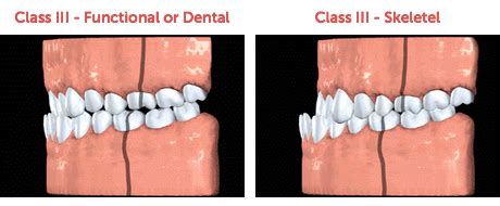 Classification Of Bites And How Orthodontics Can Help