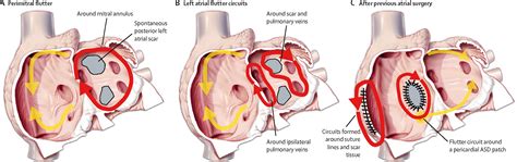 Catheter Ablation Of Atrial Arrhythmias State Of The Art The Lancet