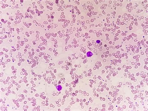 Premium Photo Chronic Myeloid Leukemia In Accelerated Phase With Thrombocytosis Chronic