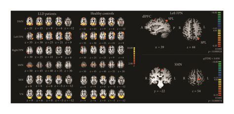 Resting State Networks Rsns In Late Life Depression Lld Left Panel Download Scientific