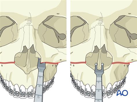 Le Fort I Osteotomy Conventional For Unilateral Cleft Lip Andor Palate