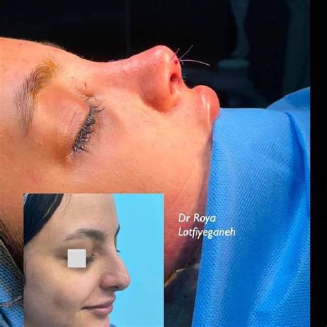 تصاویر نمونه کارهای جراحی بینی دکتر رویا لطفی یگانه