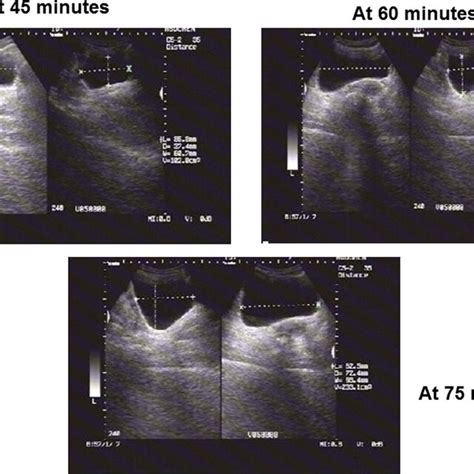 ultrasonography usg images illustrating the bladder volume estimation download scientific