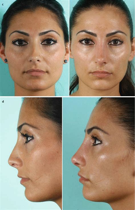 Tip Refinement In Secondary Rhinoplasty Plastic Surgery Key