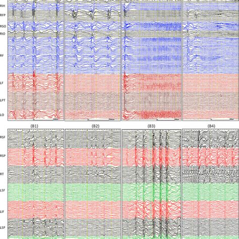 bilateral ieeg coverage and ictal onset zones before and after complete