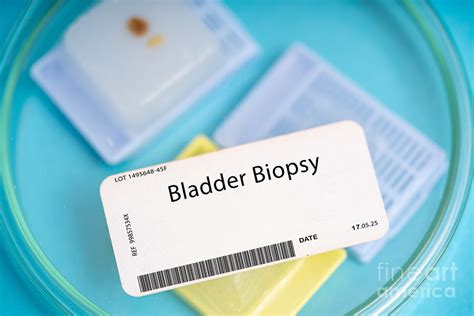 Bladder Biopsy Photograph By Wladimir Bulgarscience Photo Library Pixels Merch