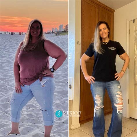 Mini Gastric Bypass Before And After Photos Mexico Bariatric Center
