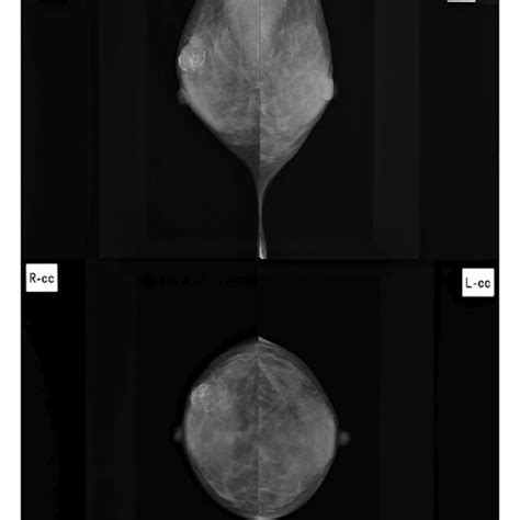 Mammography Showing A Focal Asymmetric Density With A Calcified Lesion