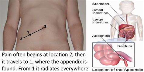 Appendix Death Appendicitis Causes Symptoms And Risks Of A Ruptured Appendix