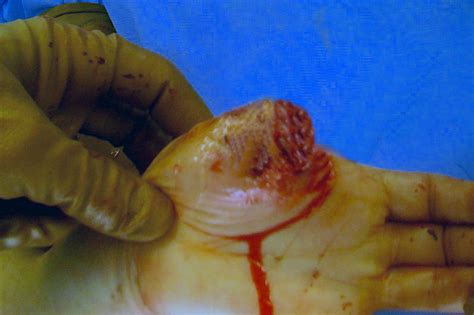 Amputation Thumb Hand Surgery Resource