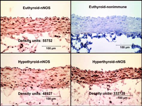 Immunohistochemical Analysis Of Euthyroid Hypothyroid And Hyperthyroid