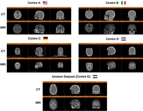 [論文レビュー] Fedsynthct Brain A Federated Learning Framework For Multi Institutional Brain Mri To