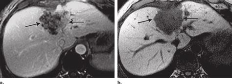 Mass Forming Peripheral Cholangiocarcinoma In A 72 Year Old Woman A Download Scientific
