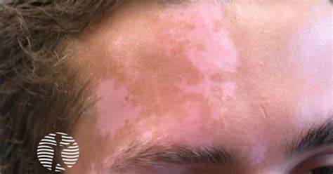 Segmental Vitiligo Image