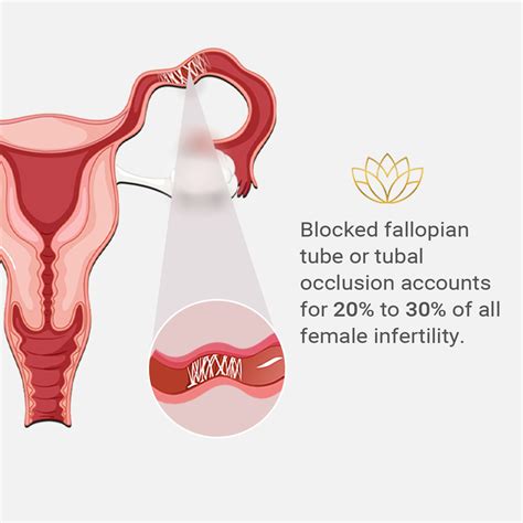 Blocked Fallopian Tube Or Tubal Occlusion Accounts For 20 To 30 Of