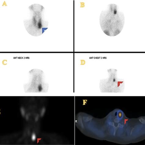 Parathyroid 99 M Tc Sestamibi Scintigraphy Spectct Showing Intensely Download Scientific