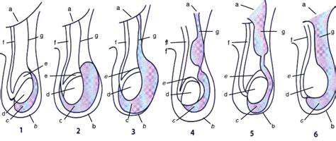 Hydrocele Of The Cord