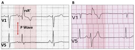 Ventricular Ectopy