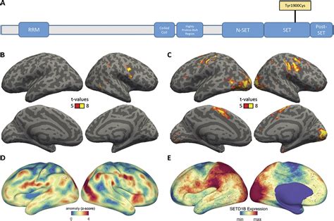 Connectome Analysis In An Individual With Setd1b Related Neu Journal Of Developmental
