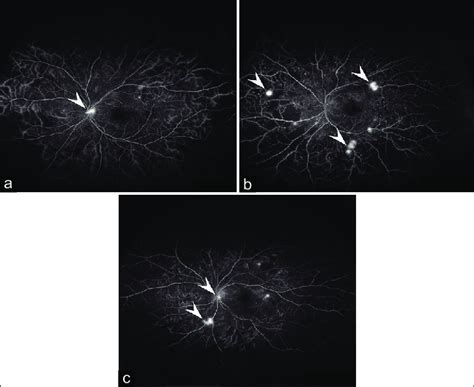 Examples Of Varying Distributions Of Neovascularization Based On Disc