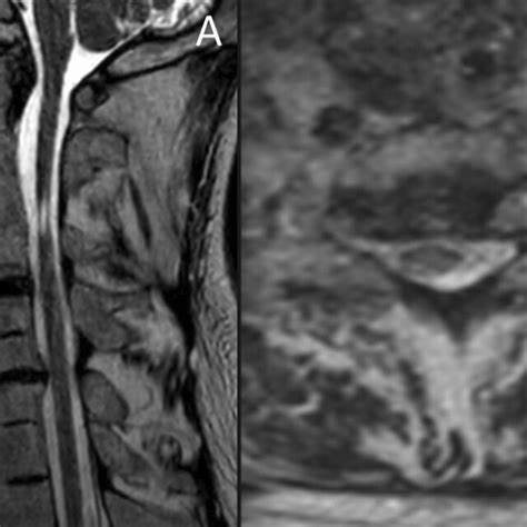 Cervical Spine T2 Sequence Magnetic Resonance Imaging A Sagittal View