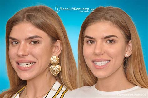 Bicuspid Teeth Extraction Reversal