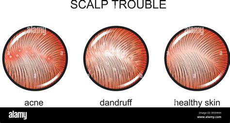 Dry Scalp Hi Res Stock Photography And Images Alamy