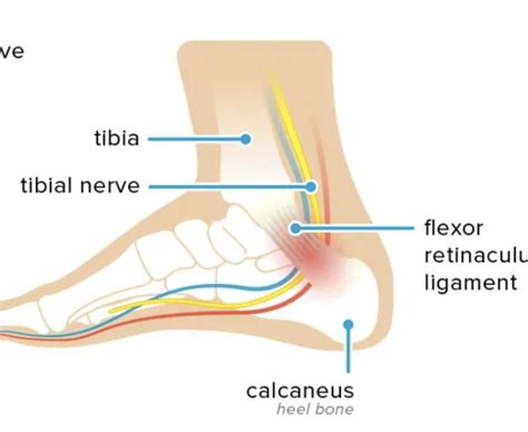 Tens Tibial Nerve Rprematureejaculation