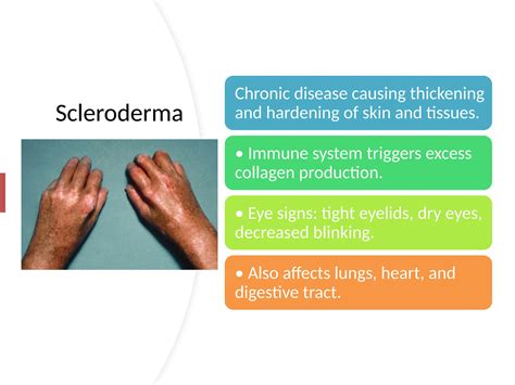Connective Tissue Diseases Preentation 1 Pptx