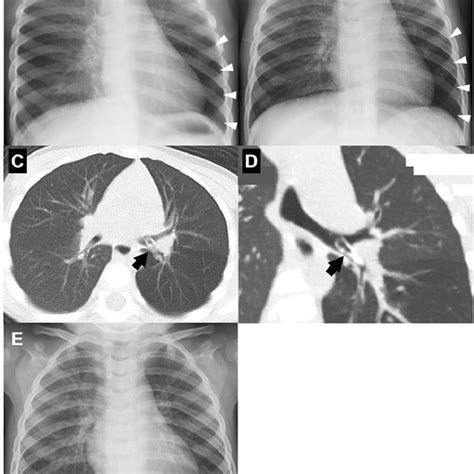 Cxr Showing Slight Emphysema Of The Left Lower Lung A Cxr On The