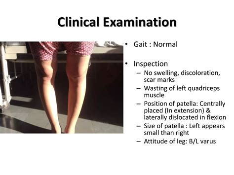 Habitual Dislocation Of Patella Pptx