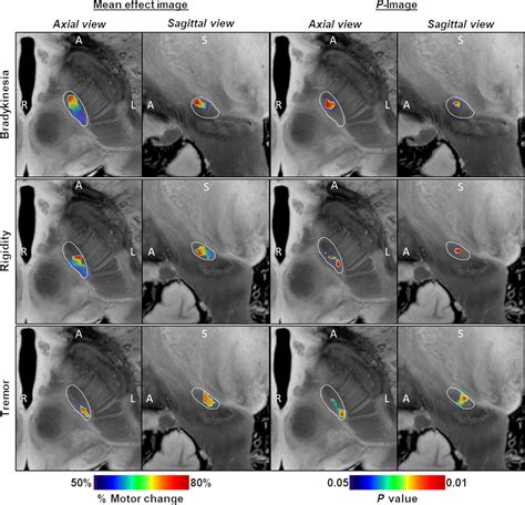 Subthalamic Nucleus Sagittal