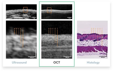 OCT Imaging For Intraoperative Margin Visualization Perimeter Medical