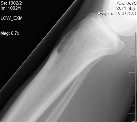 A Year Old Man With A Right Proximal Tibia Lesion BoneTumor Org