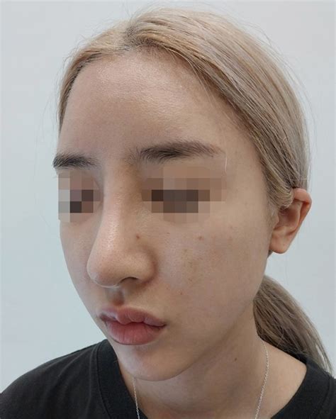 염증나서 실리콘 제거ㅠㅠ 수술후기 나를 위해 선택한 차민성형외과