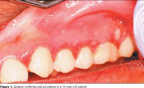 Figure 2 From A Young Patient With Persistent Gingival Bleeding