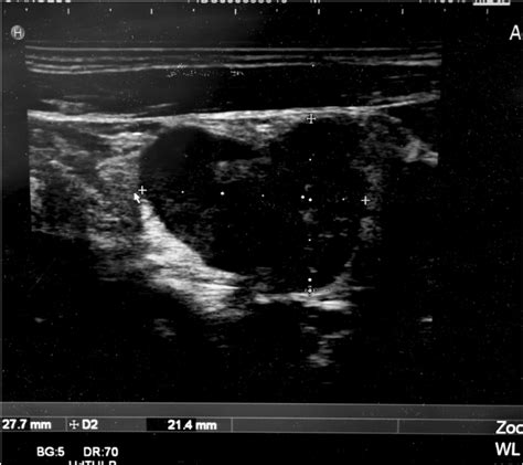 Ultrasound Image Of Lower Internal Jugular Chain Deep Cervical Lymph Download Scientific