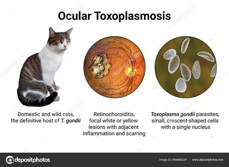 Toxoplasmosis