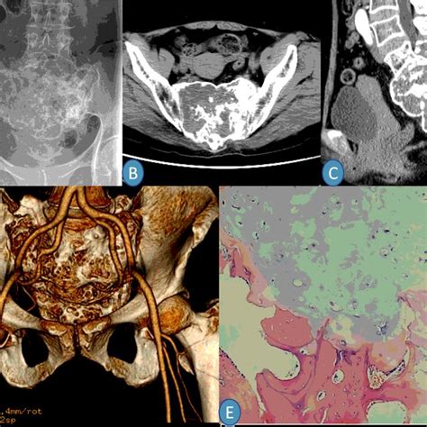 Pdf Enchondroma Of The Spine A Report Of Eleven Cases