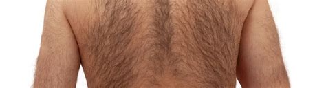 Virilization Causes Symptoms Diagnosis And Treatment