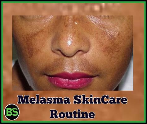 Best Melasma Treatment The Complete Guide To Get Rid Of Melasma Artofit