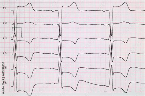 Ecg Myocardial Infarction On Ecg Subendocardial Ischemia In Chest
