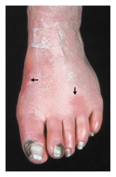 Thromboangiitis Obliterans Buergers Disease Nejm