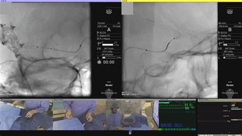 Stent Assisted Coil Embolization Of Mca Aneurysm Via A Trans Posterior Communicating Artery Stent Assisted Coil Embolization Of Mca Aneurysm Via A Trans Posterior Communicating Artery