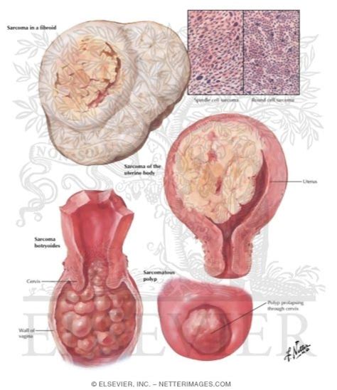 Sarcoma Botryoides