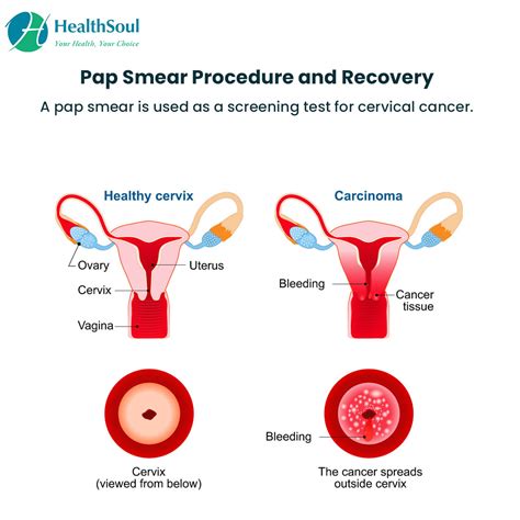 Pap Smear Information Sheet Inside Knowledge 2018 Cervical Cancer